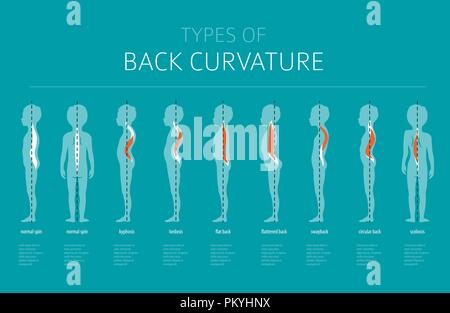 Human spine infographic. Flat illustration of human spine vector ...