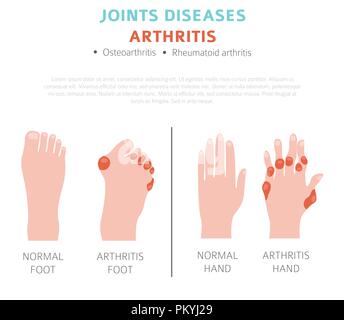 Joints diseases. Arthritis symptoms, treatment icon set. Medical ...