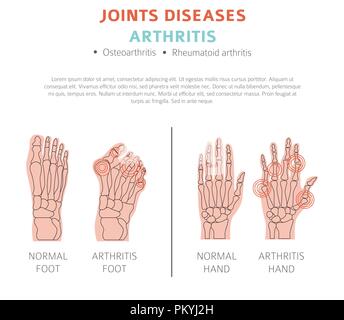 Joints diseases. Arthritis symptoms, treatment icon set. Medical ...