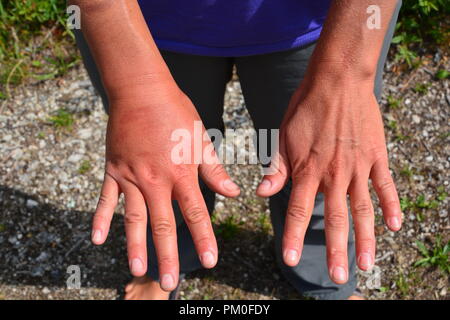 swollen hand from wasp insect sting Stock Photo - Alamy
