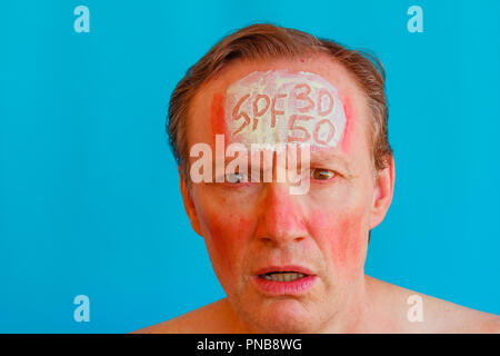 a man has a solar erythema because he did not put 30 or 50 high ...