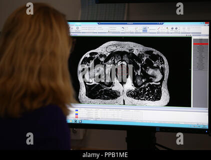 Dr Alison Tree, Consultant Clinical Oncologist at The Royal Marsden ...