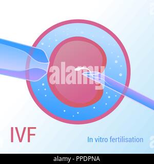 IVF. Artificial insemination. Realistic vector design 3d Stock Vector ...