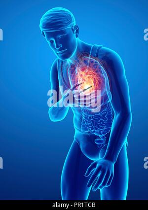 Chest Pain, Illustration Stock Photo - Alamy