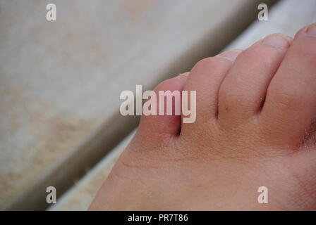 CHILD WITH HEMATOMA Stock Photo - Alamy