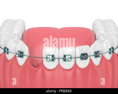 3d render of teeth with braces and cavity isolated over white ...