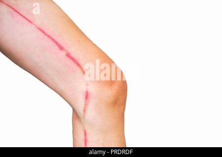 Skin inflammation with ulcer caused by insect bite. Image isolated on ...