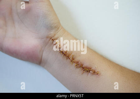 Humand hand hurt with a big scar with a lot of stitches. Horizontal ...