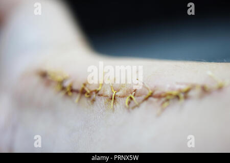 Humand hand hurt with a big scar with a lot of stitches. Horizontal ...