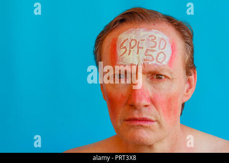 a man has a solar erythema because he did not put 30 or 50 high ...