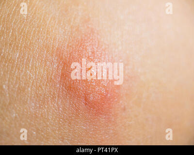 insect bites on the skin. Allergic reaction. Skin inflammation. acne ...