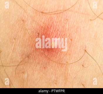A red rash on the foot of a male against background. CloseUp a part of ...