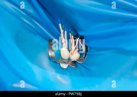 photo endodontic treatment of dental canals in the lower molar ...