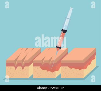 Skin subcutaneous Injection diagram illustration Stock Vector Image ...