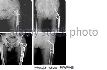 collection leg x-ray with internal fixation, high quality xray leg ...
