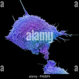 HeLa cells, coloured scanning electron micrograph (SEM). HeLa cells are ...
