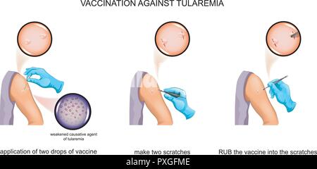 vector illustration of tularemia. hand bite. lymphadenitis and ...