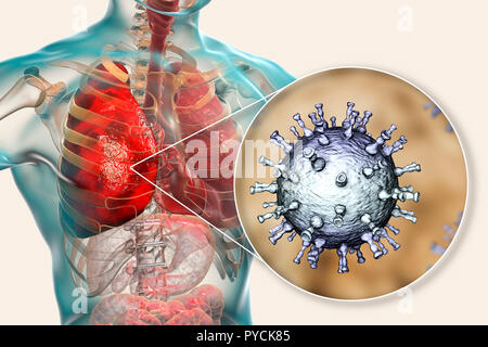 Computer illustration of a varicella zoster virus particle, the cause ...