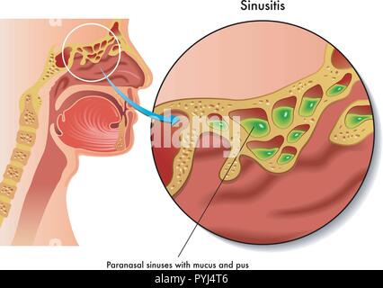 Medical illustration of symptoms of Sinusitis Stock Vector Image & Art - Alamy