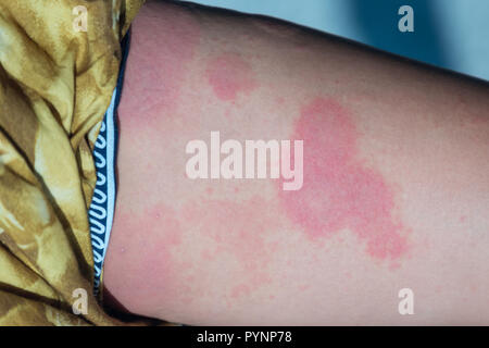 Hives on skin, red urticaria rash on a woman's body. Depicts skin ...