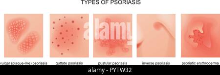 Psoriasis types. Skin hives, derma diseases. Closeup medical vector ...
