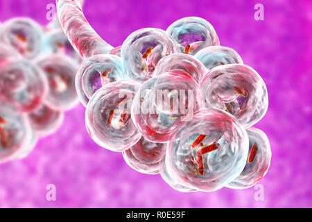 Bacterial pneumonia. Computer illustration of rod-shaped bacteria ...