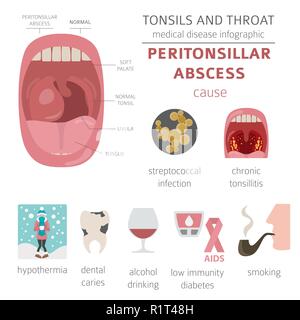 Tonsils and throat diseases. Peritonsillar abscess symptoms, treatment ...