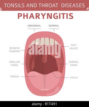 Tonsils and throat diseases. Pharyngitis symptoms, treatment icon set ...