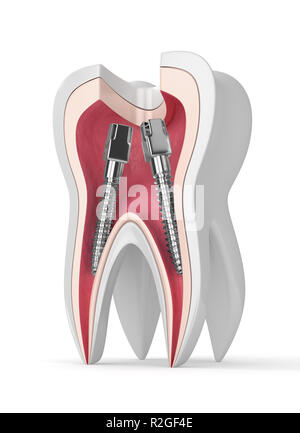 3d render of tooth with root canal treatment procedure over white ...