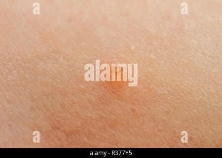 Close up of Molluscum Contagiosum also called water wart Stock Photo ...