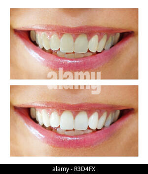 A girl s teeth before and after the dentist, example, close-up teeth ...