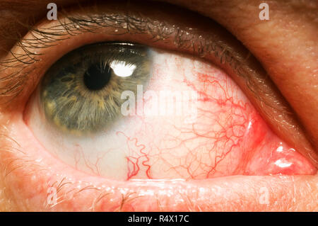 close up of a bloodshot eye looking up damage by an injury Stock Photo ...