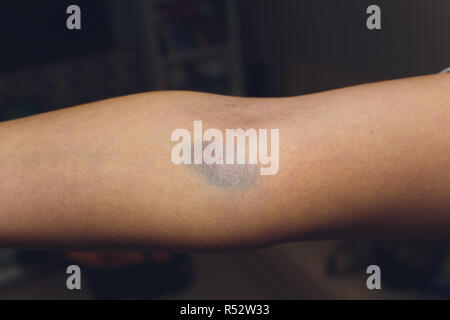 Black Bruised elbow from injection blood test , needle Stock Photo - Alamy
