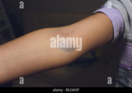 Black Bruised elbow from injection blood test , needle Stock Photo - Alamy