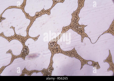 Congealed blood cells under the microscope Stock Photo - Alamy