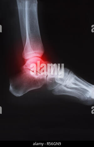 Ankle joint, X-ray Stock Photo - Alamy