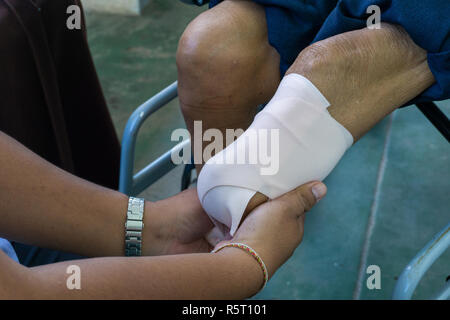 below knee stump bandaging, amputee BKA with prothesis preparing Stock ...
