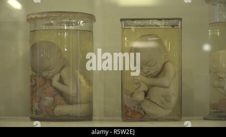 Anatomical preserved human specimens, ugliness, anomalies. Human parts ...