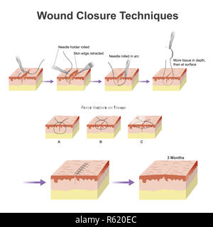 wound closure techniques Stock Photo - Alamy
