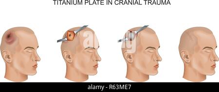 vector illustration of traumatic brain injury. titanium plate Stock ...