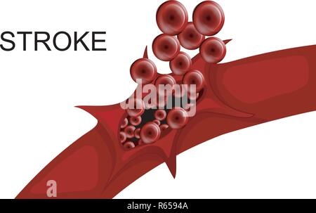 illustration of a rupture of the vessel. hemorrhagic stroke. insult ...