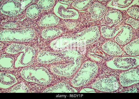 inguinal testis diseased tissue 100x Stock Photo - Alamy