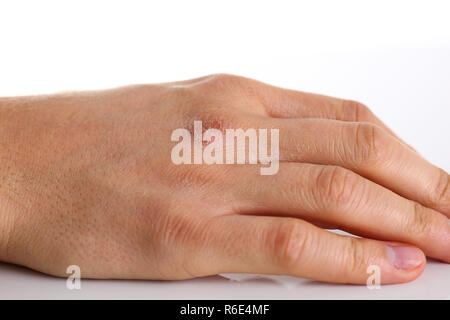 Damaged male arm with corrupted dry skin Stock Photo - Alamy