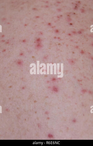 Scar on chin. Close-up of an infected scar on a patient's chin ...