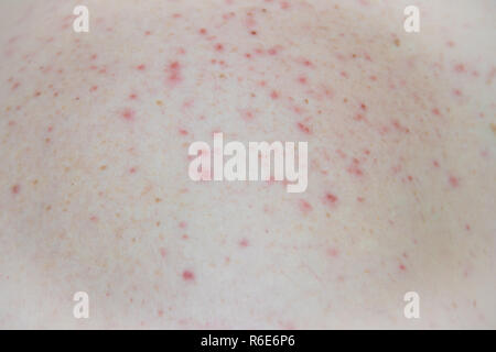 Problem skin. Acne on the skin. Texture of oily problem skin with acne ...