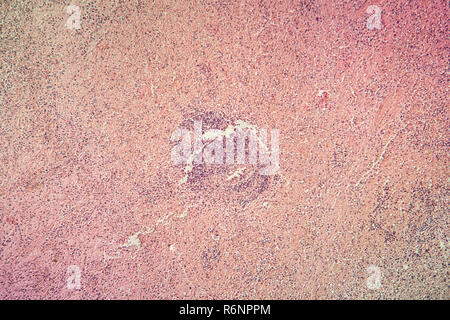 heart calluses under the microscope Stock Photo - Alamy