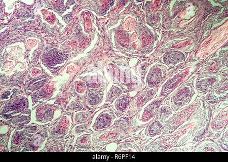 spinaliom under the microscope Stock Photo - Alamy