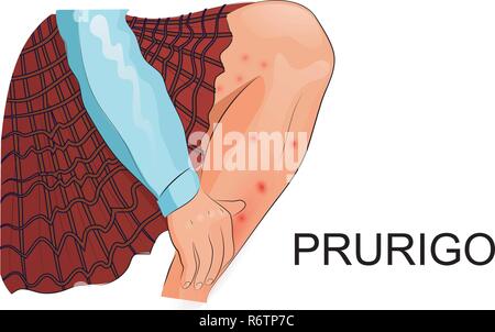 rash skin lesions disease symptom glyph icon vector illustration Stock ...