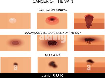 Skin cancer: Squamous cell carcinoma (disease of older cells on the ...