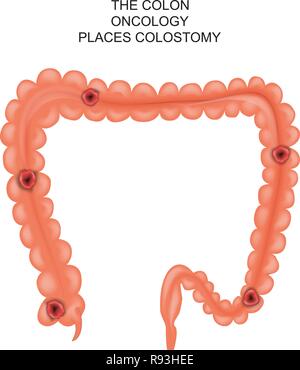 vector medical illustration of an operation of ileostomy Stock Vector ...